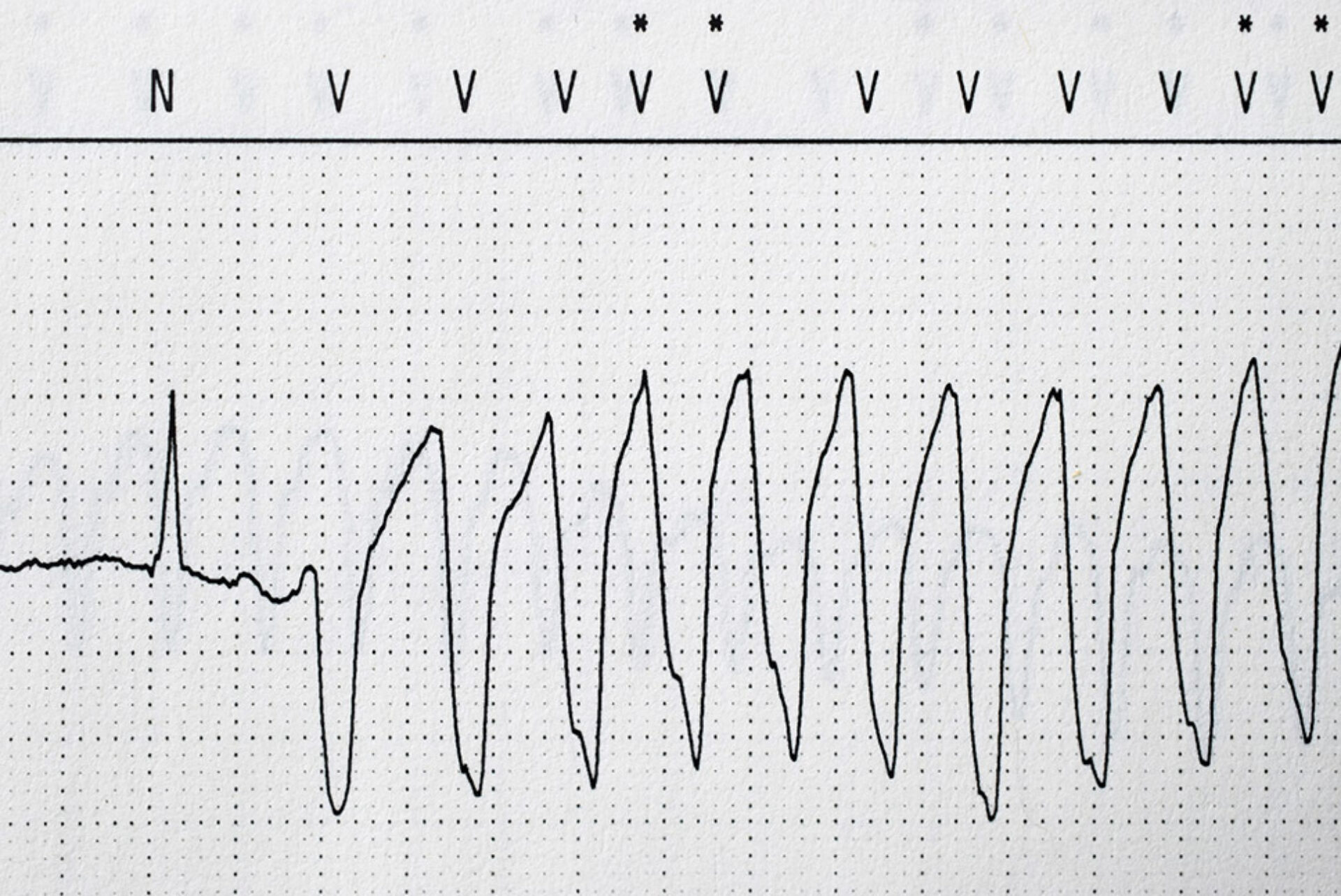 Ablation vs. Drugs for Ventricular Tachycardia | Clinician.com