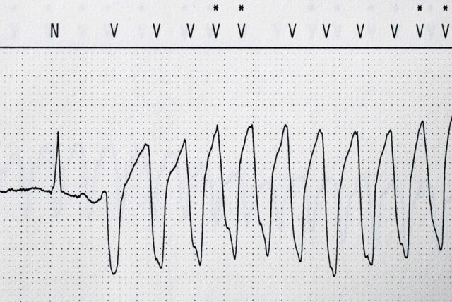 Ablation vs. Drugs for Ventricular Tachycardia | Clinician.com