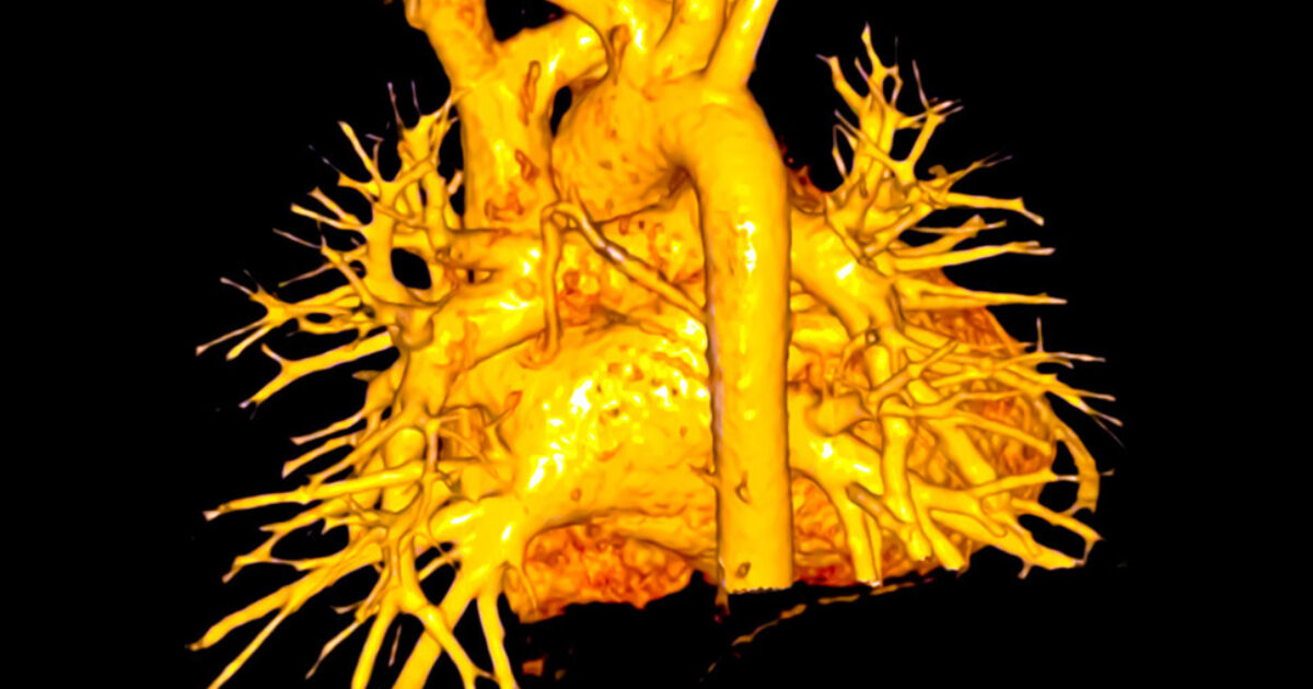 Defining Normal Ascending Aorta Size by Imaging | Clinician.com