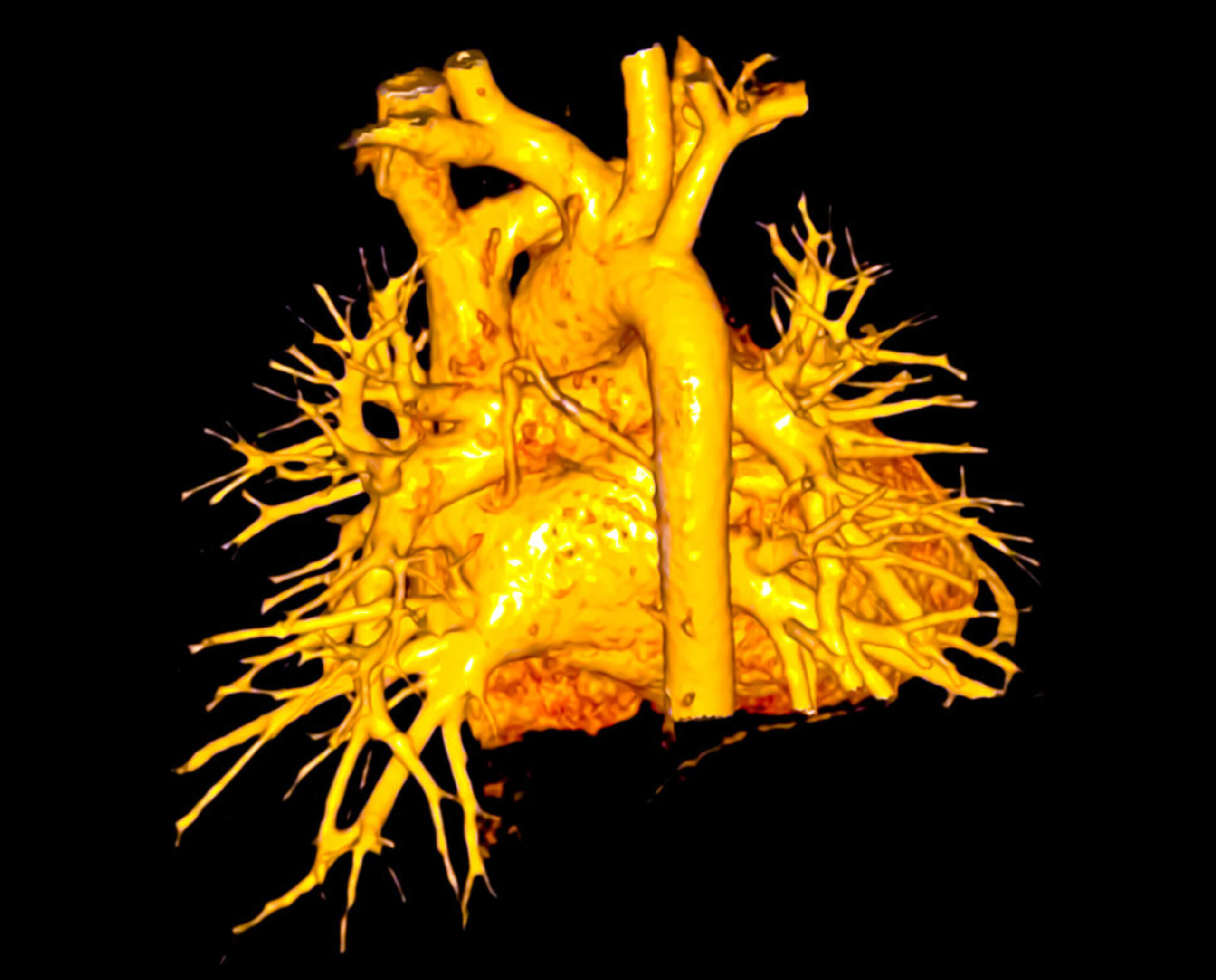 Defining Normal Ascending Aorta Size by Imaging | Clinician.com