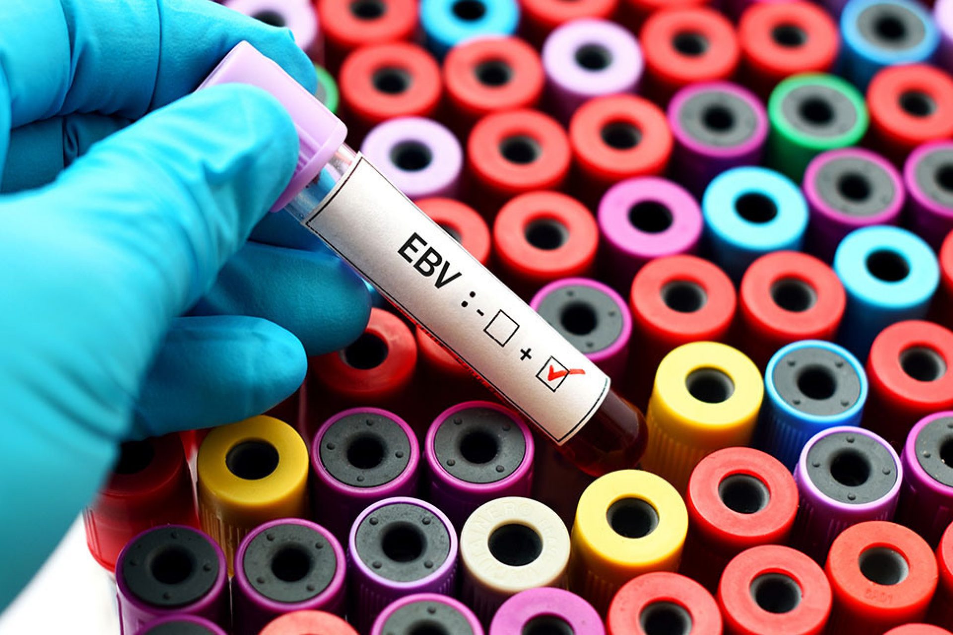 Epstein-Barr Virus and Pediatric Sepsis | Clinician.com