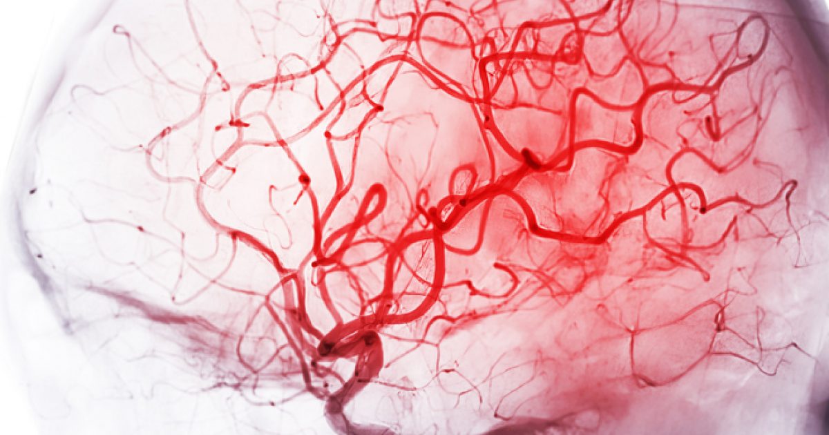 Mechanical Thrombectomy for Stroke: The Bullet Points | Clinician.com