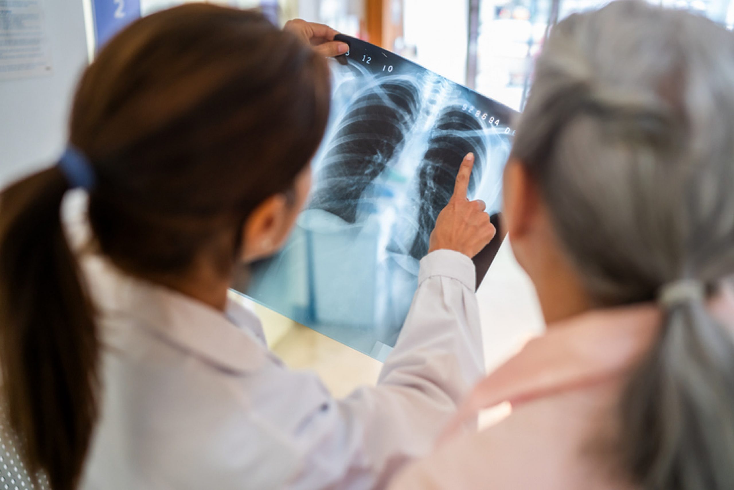 Telisotuzumab Vedotin-tlly (Emrelis) | Clinician.com