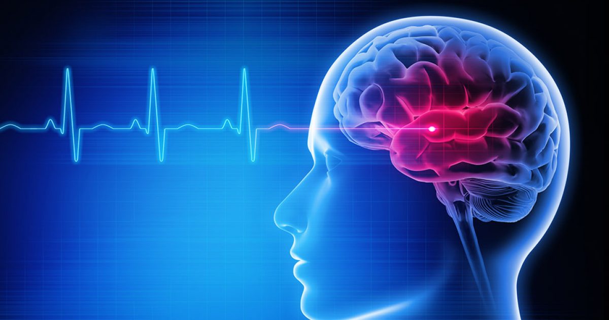 ABCD2 Score as a Predictor of Three-Year Stroke Risk | Clinician.com