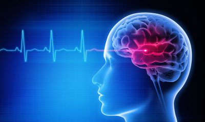 ABCD2 Score as a Predictor of Three-Year Stroke Risk | Clinician.com