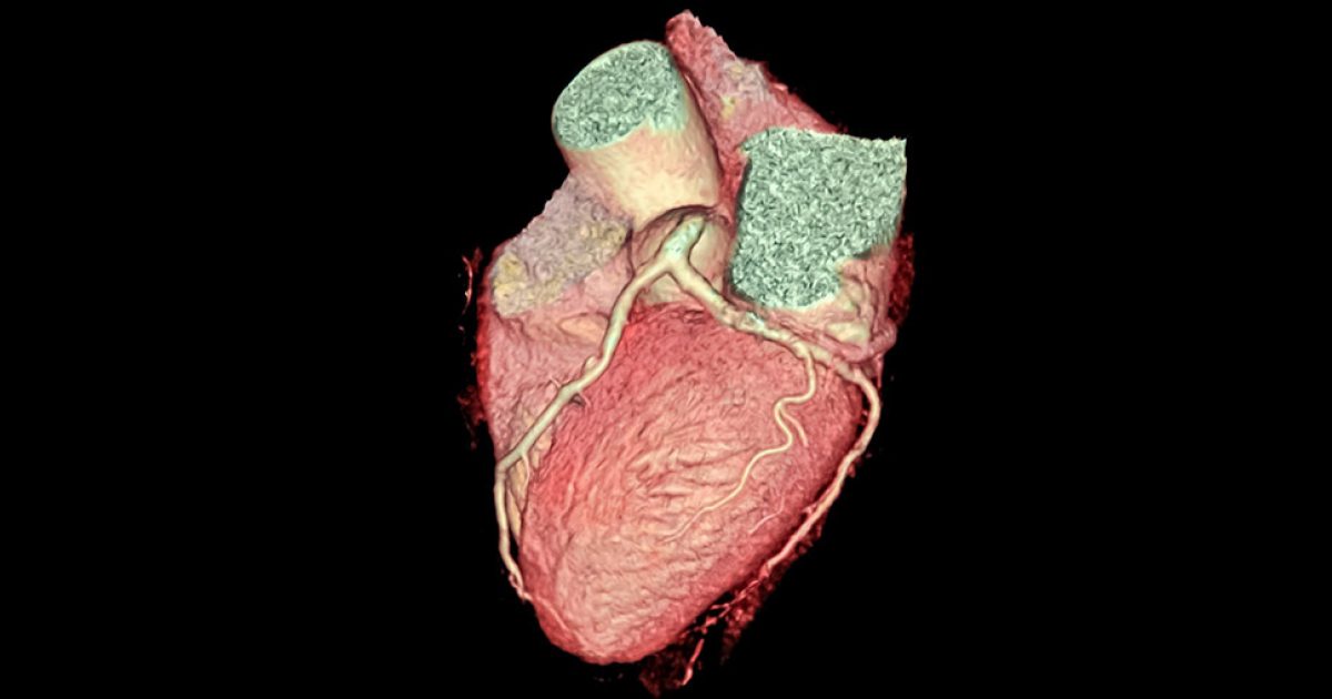 Ten-Year Outcomes of the SCOT-HEART Study | Clinician.com